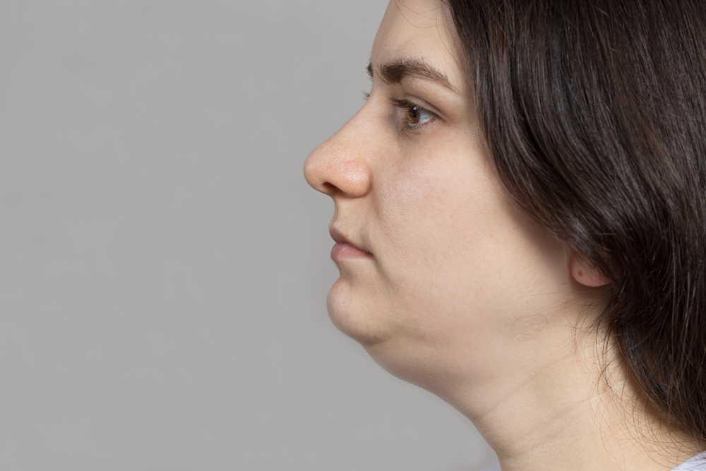 How to Treat a Double Chin - Emil A. Tanghetti, MD