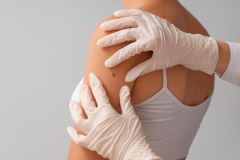 What are the Key Differences Between Normal Moles and Atypical Nevi ...