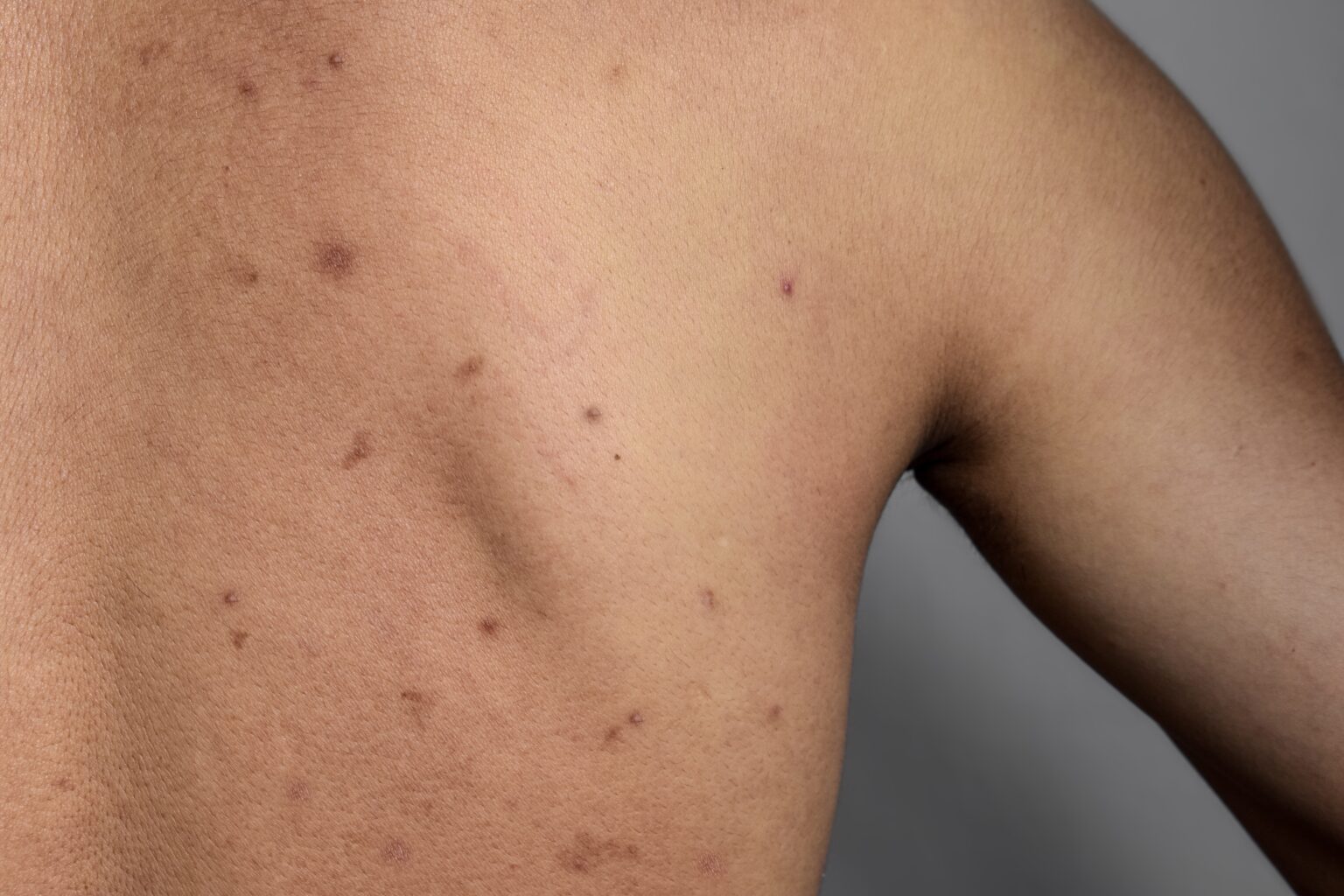 What Causes Bacne and How Do You Get Rid of It? - Emil A. Tanghetti, MD