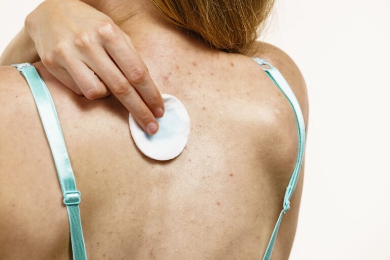 What Causes Bacne and How Do You Get Rid of It? - Emil A. Tanghetti, MD